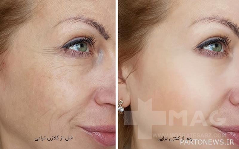 What is collagen therapy and how does it rejuvenate you? - پرتو نیوز