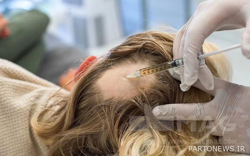 What is the real cause of hair loss? Along with the best treatment ...